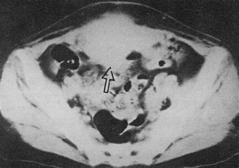 放射后纤维肉瘤 软组织病 医学