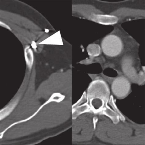 Follow Up Axial Images Obtained 10 Months After Embolization Show Download Scientific Diagram