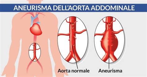 Aneurisma Dellaorta Addominale Cardio Center Napoli