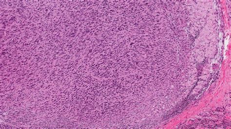 Epithelioid Malignant Peripheral Nerve Sheath Tumour Ottawa Atlas Of Pathology