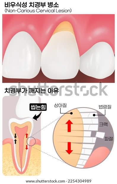 Cervical Abrasion Tooth Dentistry Stock Illustration 2254304989