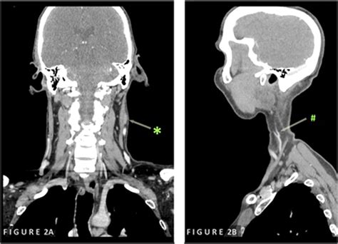 External Jugular Vein A Dsa Venous Phase After The Ligation Of