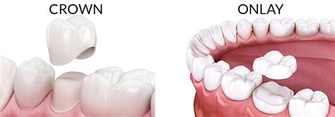 Dental Crowns And Onlays In Downtown Calgary Cooper Dental