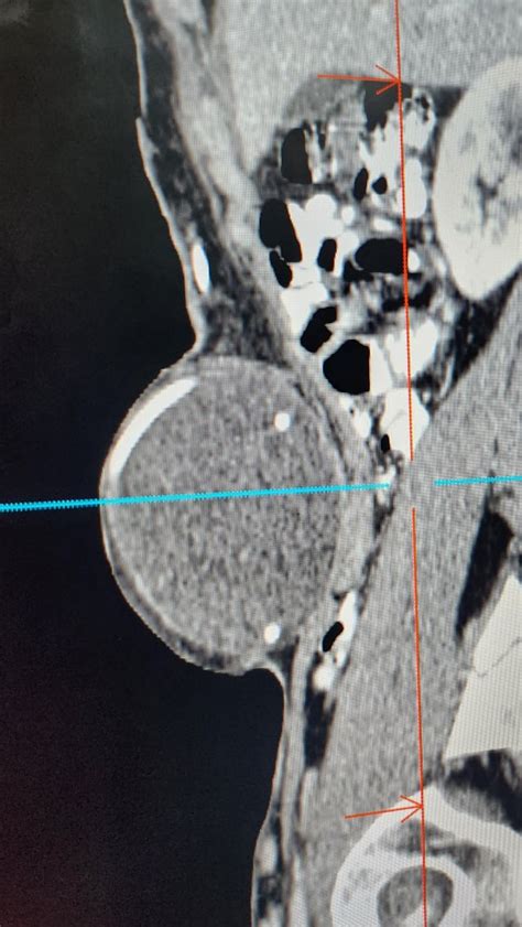 Subclinical Hypo Started Levo 25 Mcg And Felt Great For 2 Whole Weeks R Hypothyroidism