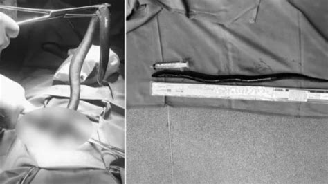 E Pazakontë Burri Ankohej Nga Dhimbja Mjekët I Gjejnë Në Stomak Një Ngjalë Të Gjallë 30