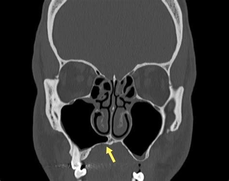 Pneumatization Of The Maxillary Sinus Into The Floor Of The Nose
