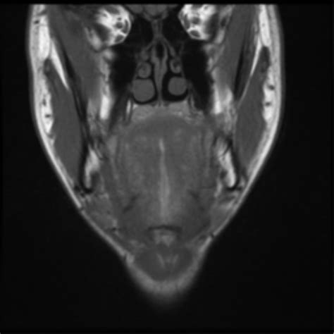Mandibular Osteomyelitis Causes At Helen Hudak Blog
