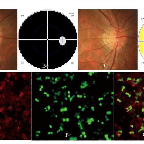Ophthalmic Examination And Cell Based Assay Cba In A Myelin