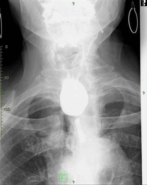 Radiology Zenkers Diverticulum At Russell Stinson Blog