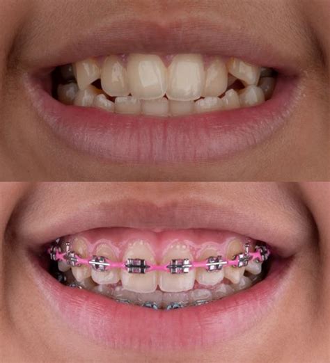 Heart Dental Complete Dental Care In Carson Long Beach Gardena Torrance And Beyond Complete