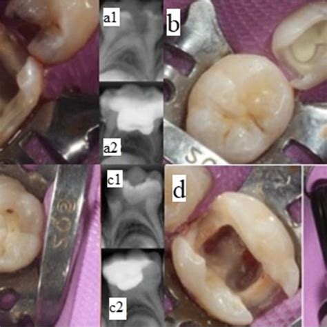Pre Operative Radiograph For Formocresol Pulpotomy Group B Download