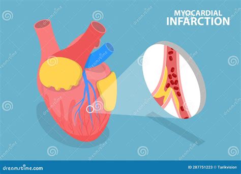 3d Ilustración Conceptual Isométrica Plana Vectorial Del Infarto De