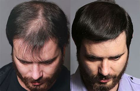 Hair Transplant Beforeafter Results For Men Bosley Hair Transplant
