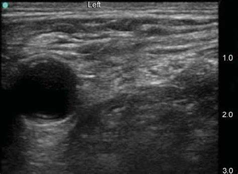 A Example Of Ultrasound Image Captured At The Level Of The Inguinal