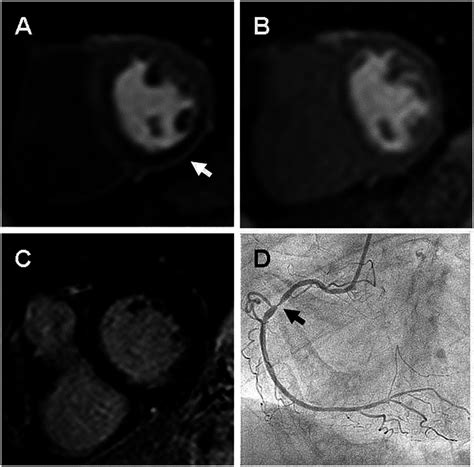 A Basal Short Axis View With Perfusion Deficit At Stress Arrow B