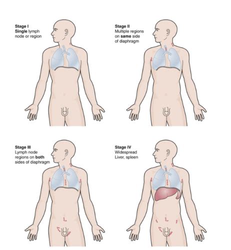 Chap 11 Lymphatic System Disorders Flashcards Quizlet
