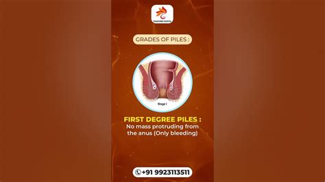 Understanding Hemorrhoid Classification Hemorrhoidgrades