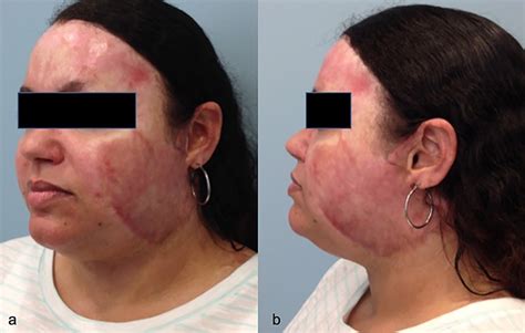 Laser Management Of Hypertrophic Burn Scars A Comprehensive Review Pmc