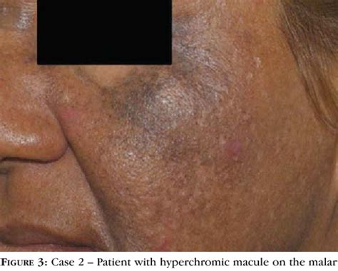 Pdf Use Of Dermoscopy For Diagnosis Of Exogenous Ochronosis