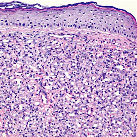 Pathology Outlines Primary Cutaneous Diffuse Large B Cell Lymphoma