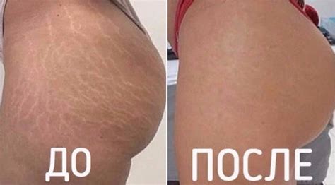 Удаление растяжек