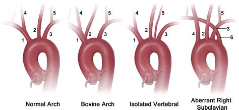 Atypical Aortic Arch Branching Variants A Novel Marker For Thoracic