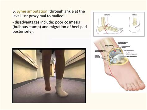 Amputation And Disarticulation Pptx