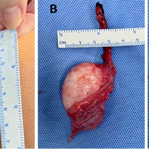 Treatment Algorithm Suggested By The Authors To Treat All Cases