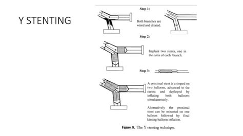 Classification Of Bifurcation Lesion Angioplasty Pptx