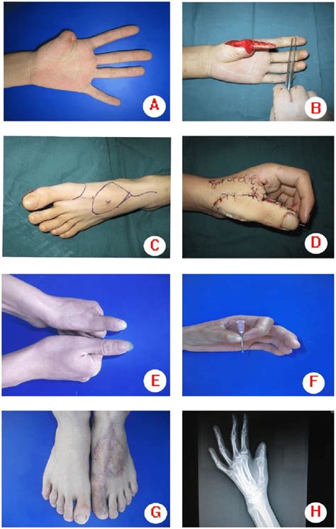 A Preoperative Defect Proximal To Metacarpophalangeal Joint In The Download Scientific
