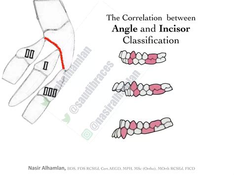 The Relation Between Skeletal Pattern And Malocclusion Incisor And