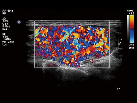 Imaging Evaluation Of Amiodarone Induced Thyroid Dysfunction