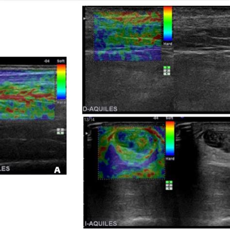 Strain Elastography A Normal Stiffness B Abnormal Elasticity Greater Download Scientific
