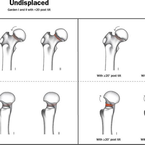 Proposed Modified Garden Classification Of Undisplaced And Displaced Download Scientific