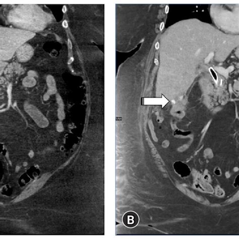 Pdf Percutaneous Endoscopy Peritoneoscopy And Lithotripsy For Retrieval Of Dropped