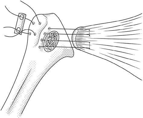 Sketch Of The Lesser Tuberosity Osteotomy Repair Technique Featuring