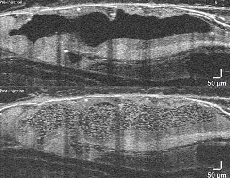 stage 49 post bead injection