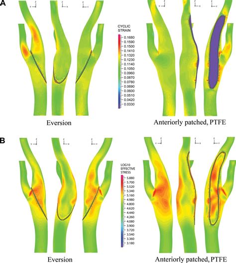 A Mathematical Evaluation Of Hemodynamic Parameters After Carotid