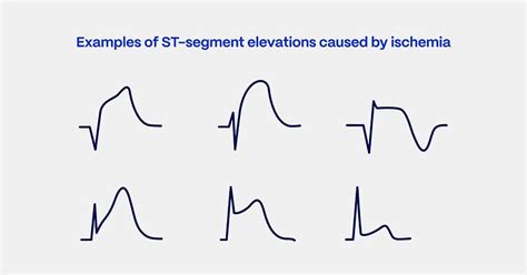Stemi Ecg Criteria Key Insights Into Ischemic St Elevation Patterns