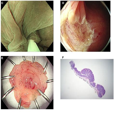 A Case Of Modified Underwater Endoscopic Mucosal Resection A Download Scientific Diagram