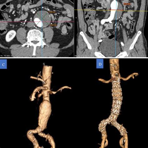 A B Ct Angiogram Showed A 51 Mm Infrarenal Abdominal Aortic