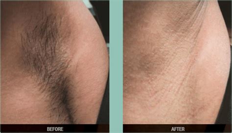 Laser Hair Removal Twin Falls Hairsxe