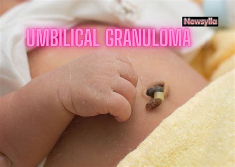 Umbilical Granuloma In Newborns Symptoms And Treatment