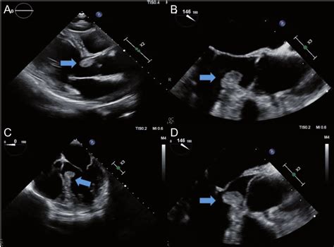 A Parasternal Long Axis View Of The Mass In Lvot Arrowhead B Download Scientific
