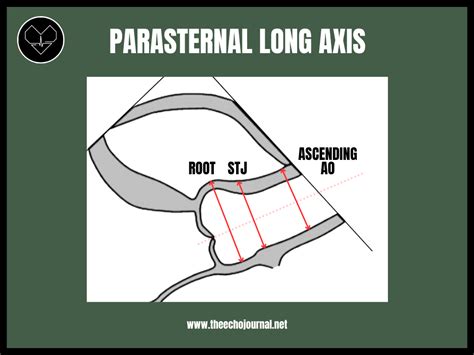 Ruptured Sinus Of Valsalva The Echo Journal
