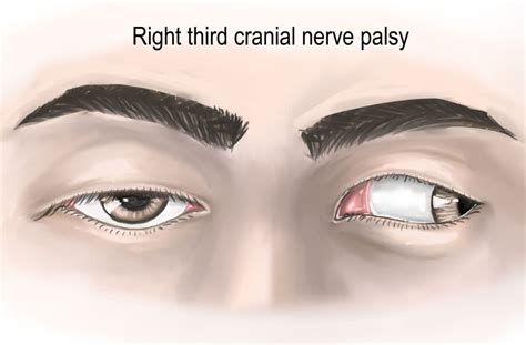 Third Nerve Palsy Causes Symptoms And Treatment
