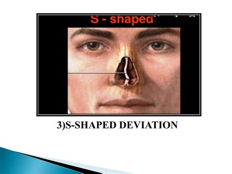 Deviated Nasal Septum By Bhumikagthakor Pptx