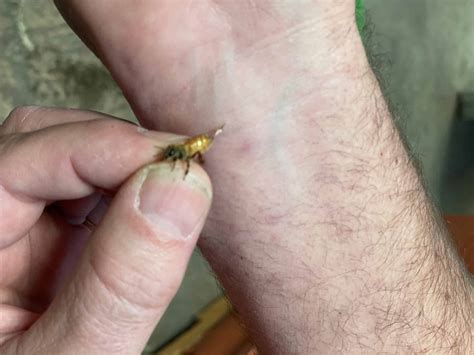 Bee Venom Therapy Bees Healing Apitherapy Stock