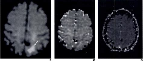 Figure 2 From Use Of Mr Exponential Diffusion Weighted Images To