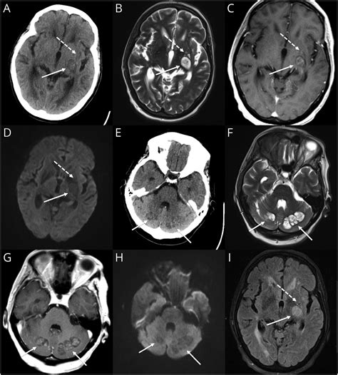 Teaching Neuroimage Cryptococcal Meningoencephalitis With Cryptococcoma And Gelatinous